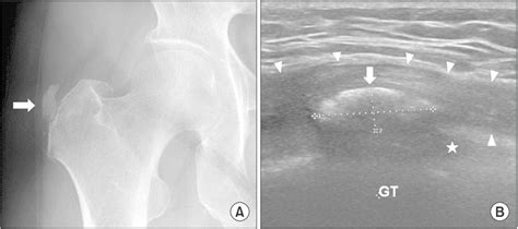 A An Anteroposterior Radiograph Of The Right Hip Showing An Amorphous Download Scientific