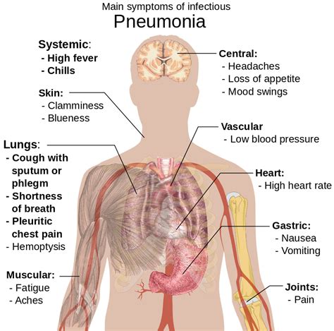 Difference Between Pneumonia And Lung Infection Difference Between