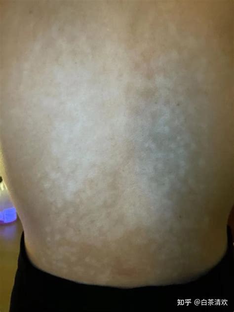 Pmh 进行性斑状色素减退 知乎