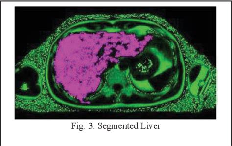 Figure 3 From Automatic Liver And Subcutaneous Fat Segmentation From Mri Pdff Images Semantic