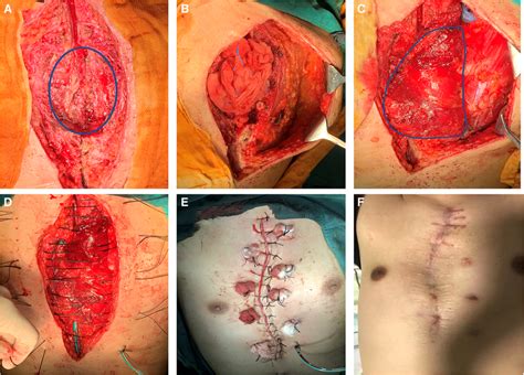 Surgical Procedure And Postoperative Photos A Infected Sternum And