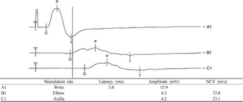 Demyelinating Pattern With Conduction Block And Tempora Open I