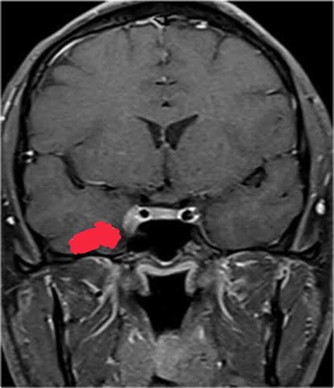 E Mri Brain Showing Enhancement In Rt Cavernous Sinus Mri Magnetic
