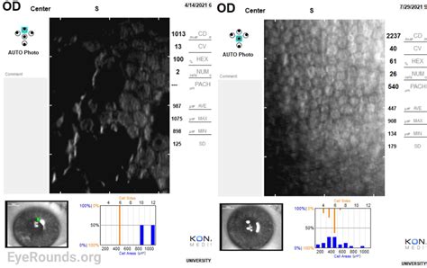 Fuchs Endothelial Corneal Dystrophy