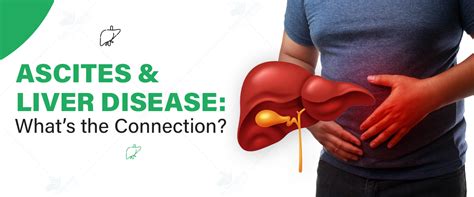 Ascites And Liver Disease Whats The Connection