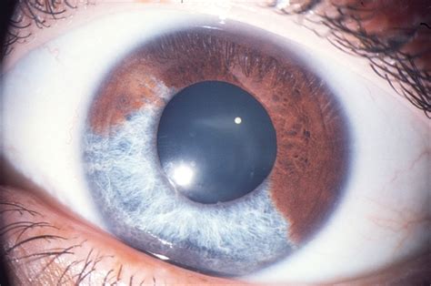 Inferior Sector Iris Atrophy With Depigmentation Retina Image Bank