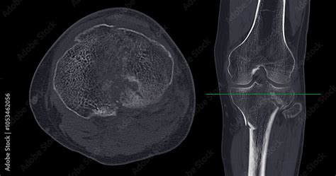 Ct Imaging Of Tibia And Fibula Fracture In Trauma Case A Detailed Ct Scan Highlighting A