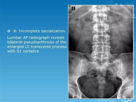 Transitional Vertebrae Radiology Pptx