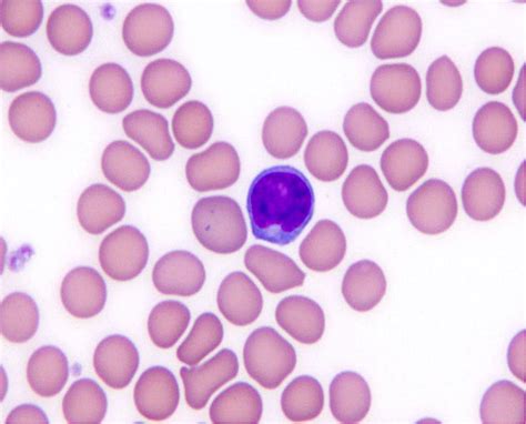 Pathology Outlines Follicular Usual