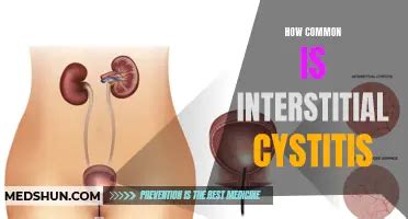 Understanding The Connection Between Interstitial Cystitis And Post Sex Pain MedShun