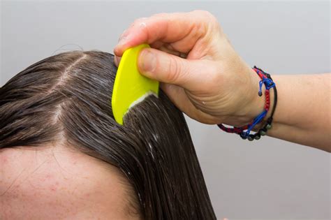 Lice Signs Treatments And How Its Spread Berea Mail