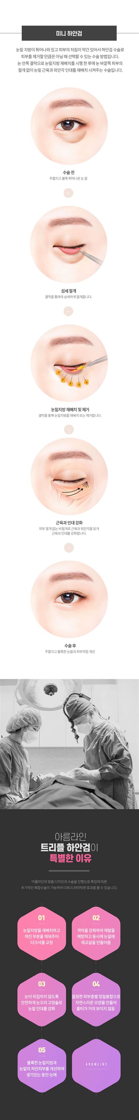 트리플 하안검 쌍커풀 자연유착 비절개뒤트임 눈꼬리올림 트임재수술 윗트임 이마거상 미니거상