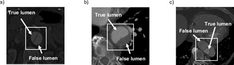 Figure 1 From Context Aware Convolutional Neural Networks For Segmentation Of Aortic Dissection