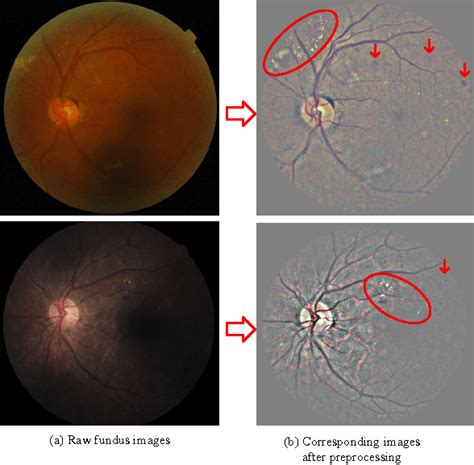 lesion detection and grading of diabetic retinopathy via two stages