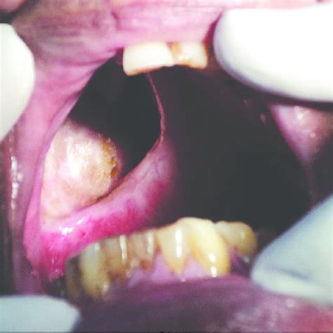 Pdf Rehabilitation Of A Partial Maxillary Defect With Magnet Retained