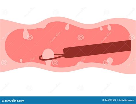 Colonoscopy Intestine Polypectomy Procedure Removal Polyp In Colon Checkup Gut Colon Surgery
