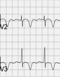 T Wave LITFL ECG Library Basics