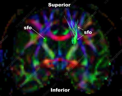 Superior Longitudinal Fasciculus Dti