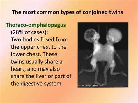 Ppt Conjoined Twins Powerpoint Presentation Free Download Id2703493