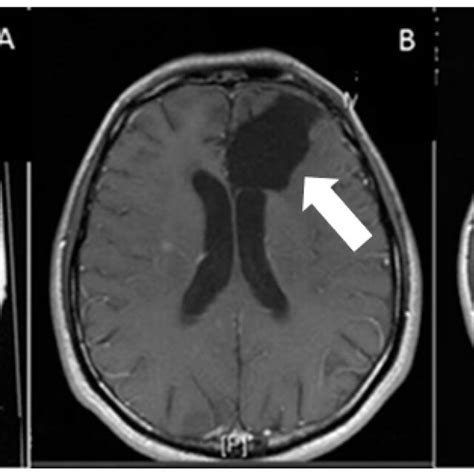 Post Gadolinium Contrast Administration T1 Weighted Axial Images A