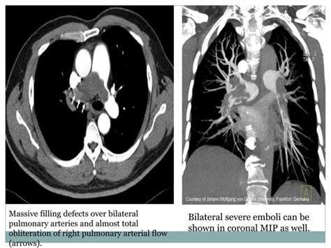 Pulmonary Embolism Radiology Pptx
