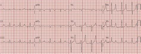 Hyperkalemia With Cardiac Arrest Peaked T Waves Hyperacute Stemi Vs Early Repolarizaton Vs