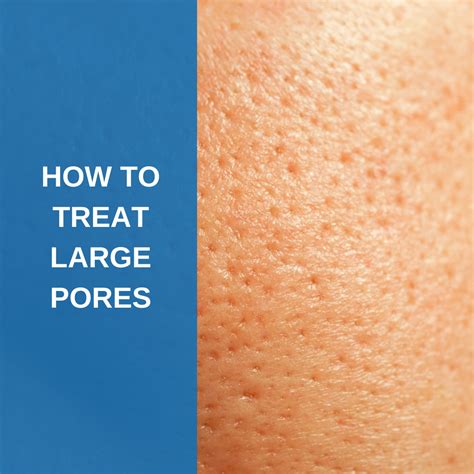 Large Pores On Cheeks Causes