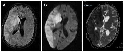 Diffusion Weighted Imaging Technique And Applications