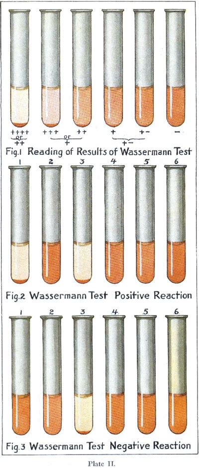 Reading Of Results Of The Wasserman Test Craig Charles Franklin The