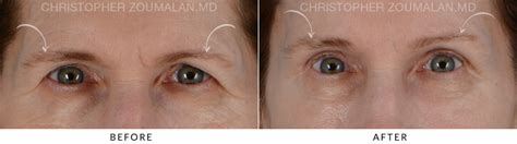 Endoscopic Brow Lift Before And After Photo Gallery