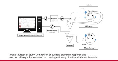 Med El On Linkedin Comparison Of Auditory Brainstem Response And Electrocochleography To