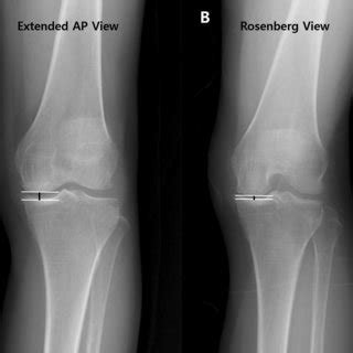 The Joint Space Width JSW Measured The Shortest Vertical Distance Download Scientific Diagram