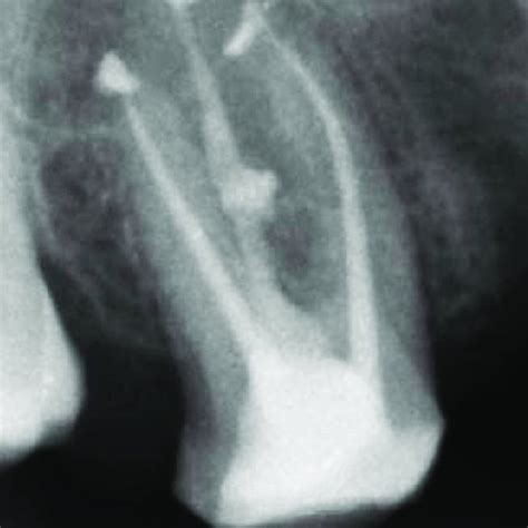 Rodetes Gingivales Al Nacimiento Contacto Frontal Y Lateral De Los
