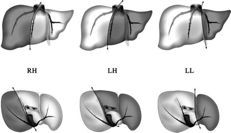 Three Hepatectomies Are Depicted Right Hepatectomy Left Hepatectomy