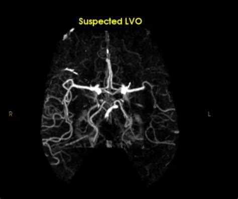Comparative Ai Study Shows Merits Of Rapidai Lvo Software In Stroke