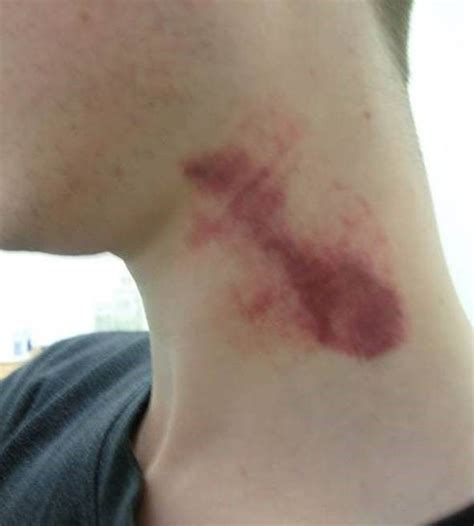 Worst Hickey Ever