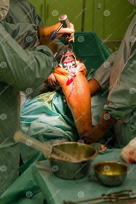 Knee Joint Replacement Prosthesis Stock Image Image Of Endoprosthesis Hospital 148827113