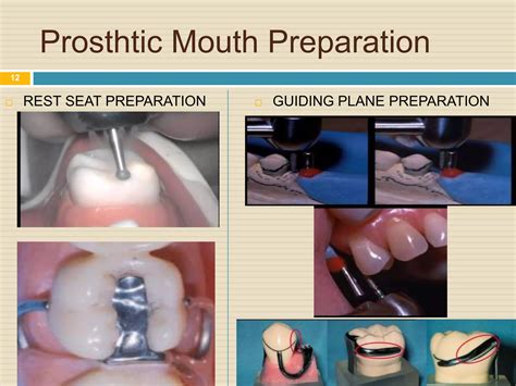 Steps Of Fabrication Of Removable Partial Denture Pptx