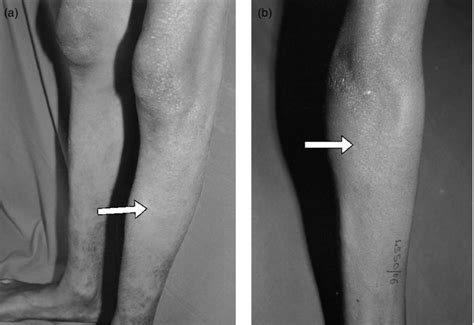 A Clinical Photographofthe Patient Sleft Leg Showing Swelling Over Download Scientific
