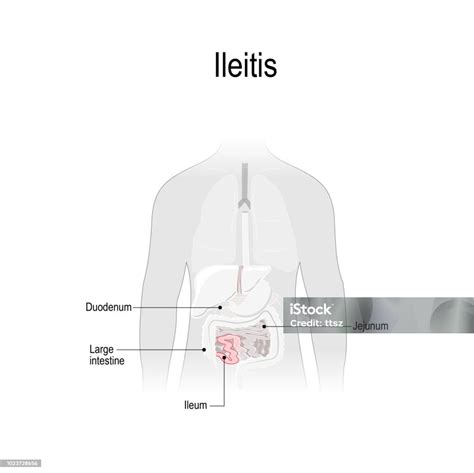 Ileitis Ilustrasi Stok Unduh Gambar Sekarang Anatomi Arah Konsep