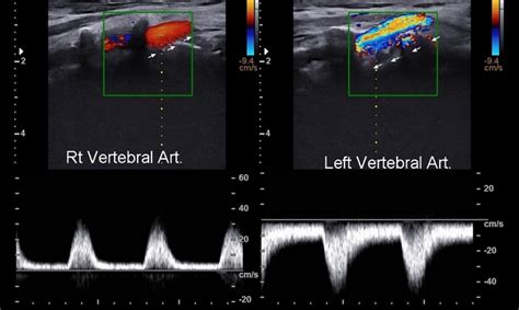 Subclavian Steal Syndrome Ultrasound