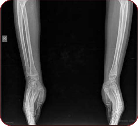 Lateral View Of Both Hands Indicates The Lesion At The Right Capitate