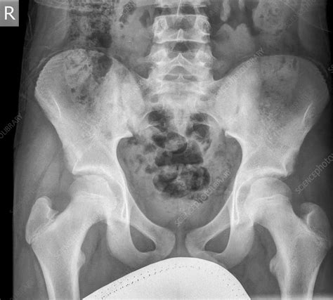 Hip X Ray Anatomy