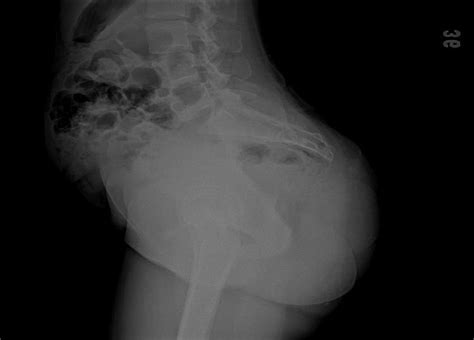 Total Excision Postoperative View Download Scientific Diagram