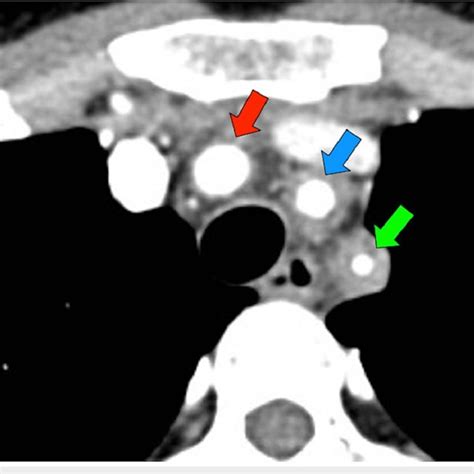 Contrast Enhanced Computed Tomography Scan Axial View Exhibiting Wall Download Scientific