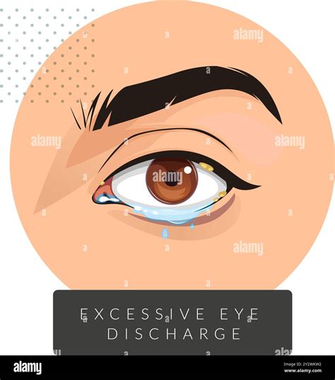 Conjunctivitis Discharge Cut Out Stock Images And Pictures Alamy