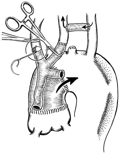 Carotid Subclavian Bypass