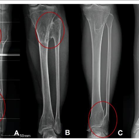Measurement Of Radiographic Angle Of Mpta And Ldta The Mpta Is
