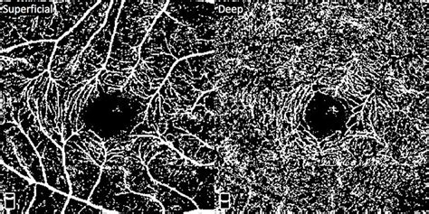 OCT A Imaging Of The SCP And DCP After Binarization Using The Niblack Download Scientific