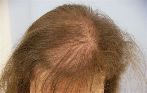 Telogen Effluvium DSSurgery
